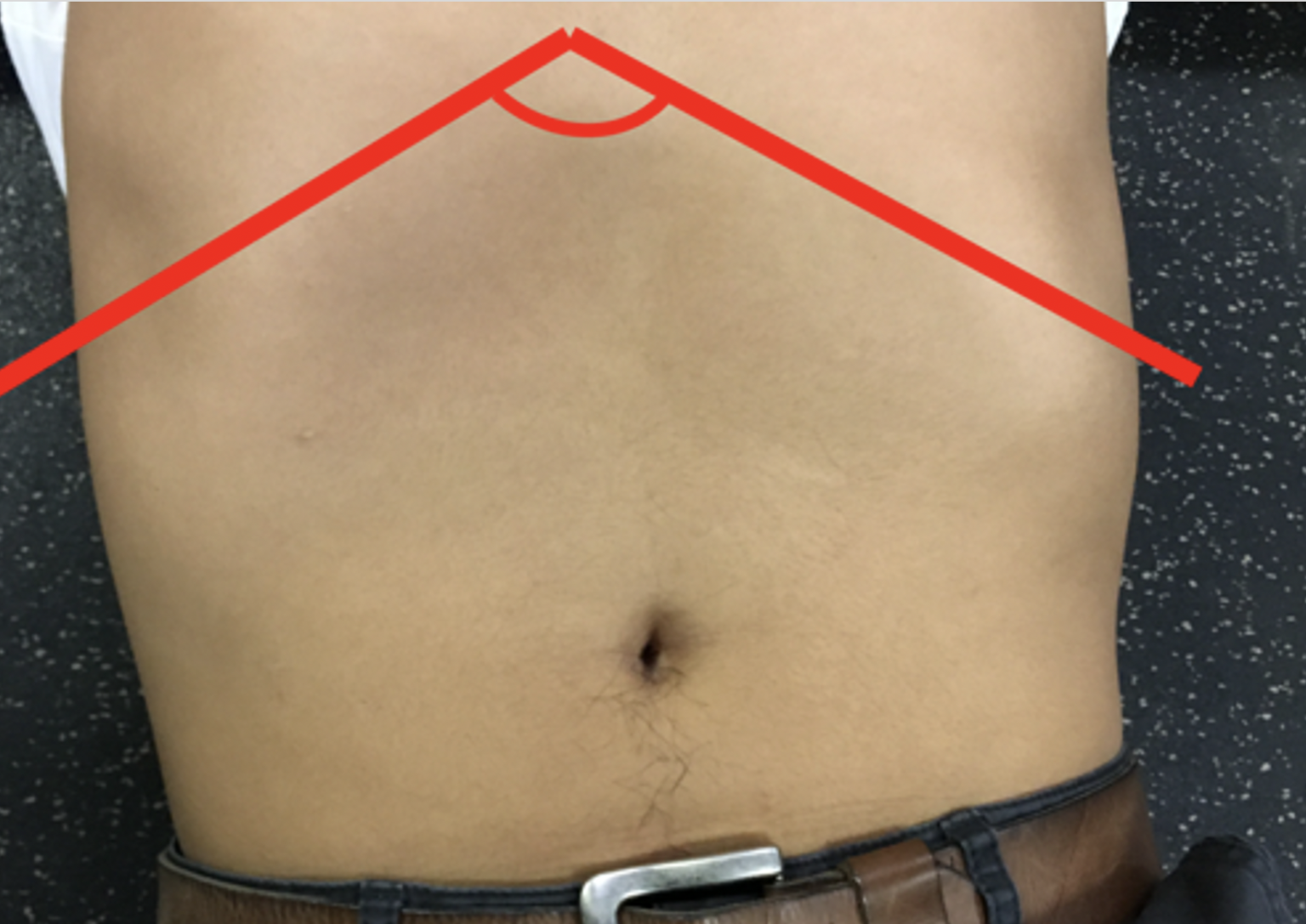 Infrasternal Angle Treatment 101 – ZacCupples.com