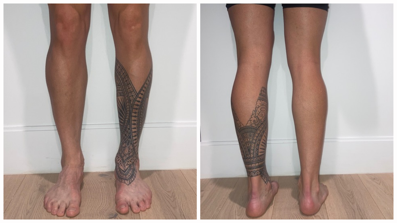 Have Knee Pain? Untwist It | Narrow Infrasternal Angle Case ...