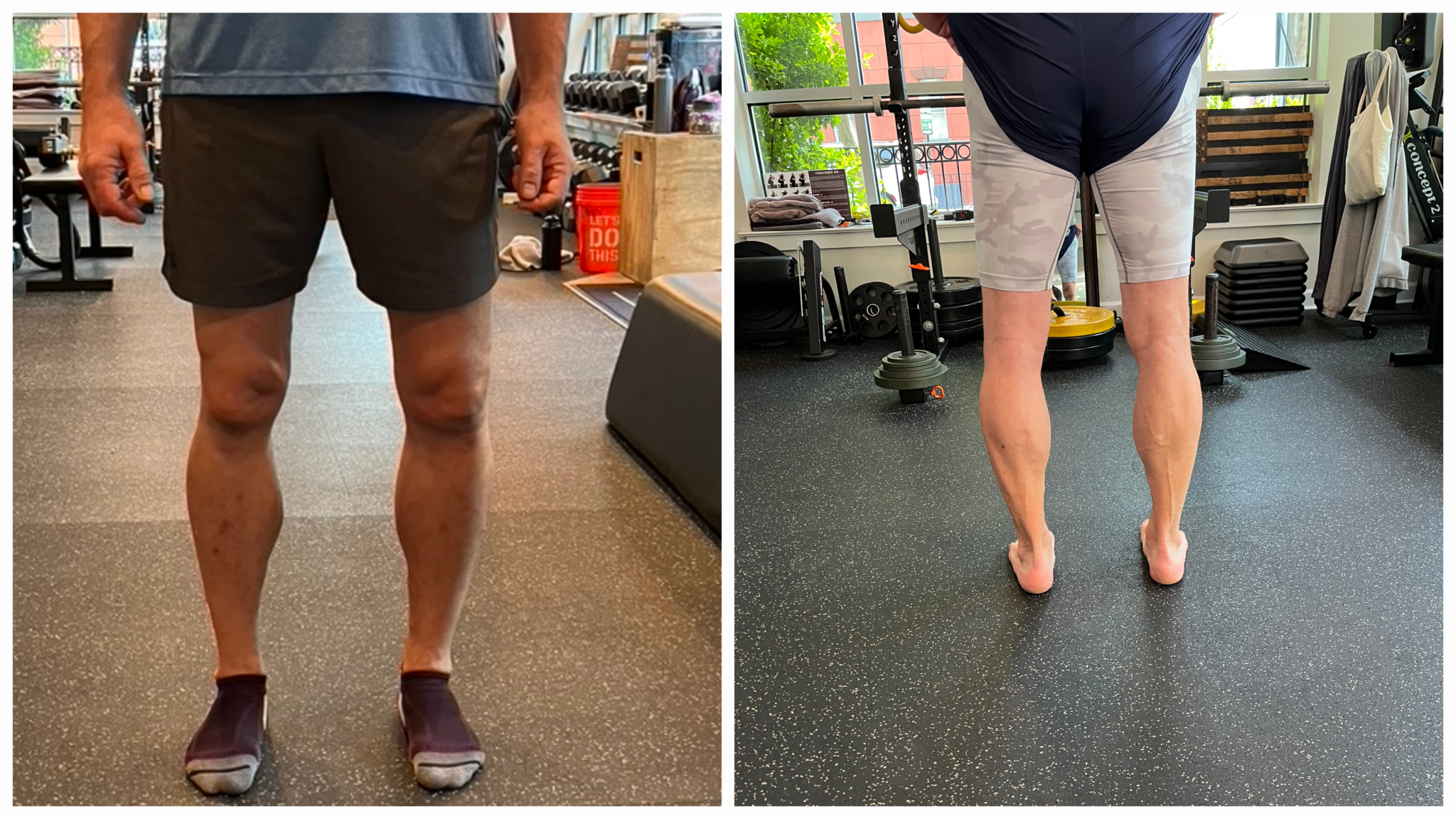 Have Knee Pain? Untwist It | Wide Infrasternal Angle Case – ZacCupples.com